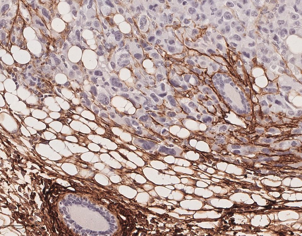Tumour microenvironment: From tumour heterogeneity to therapy ...